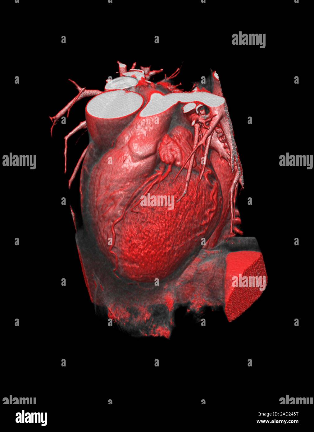 Human heart, computed tomography (CT) scan. The scan shows some of the ...