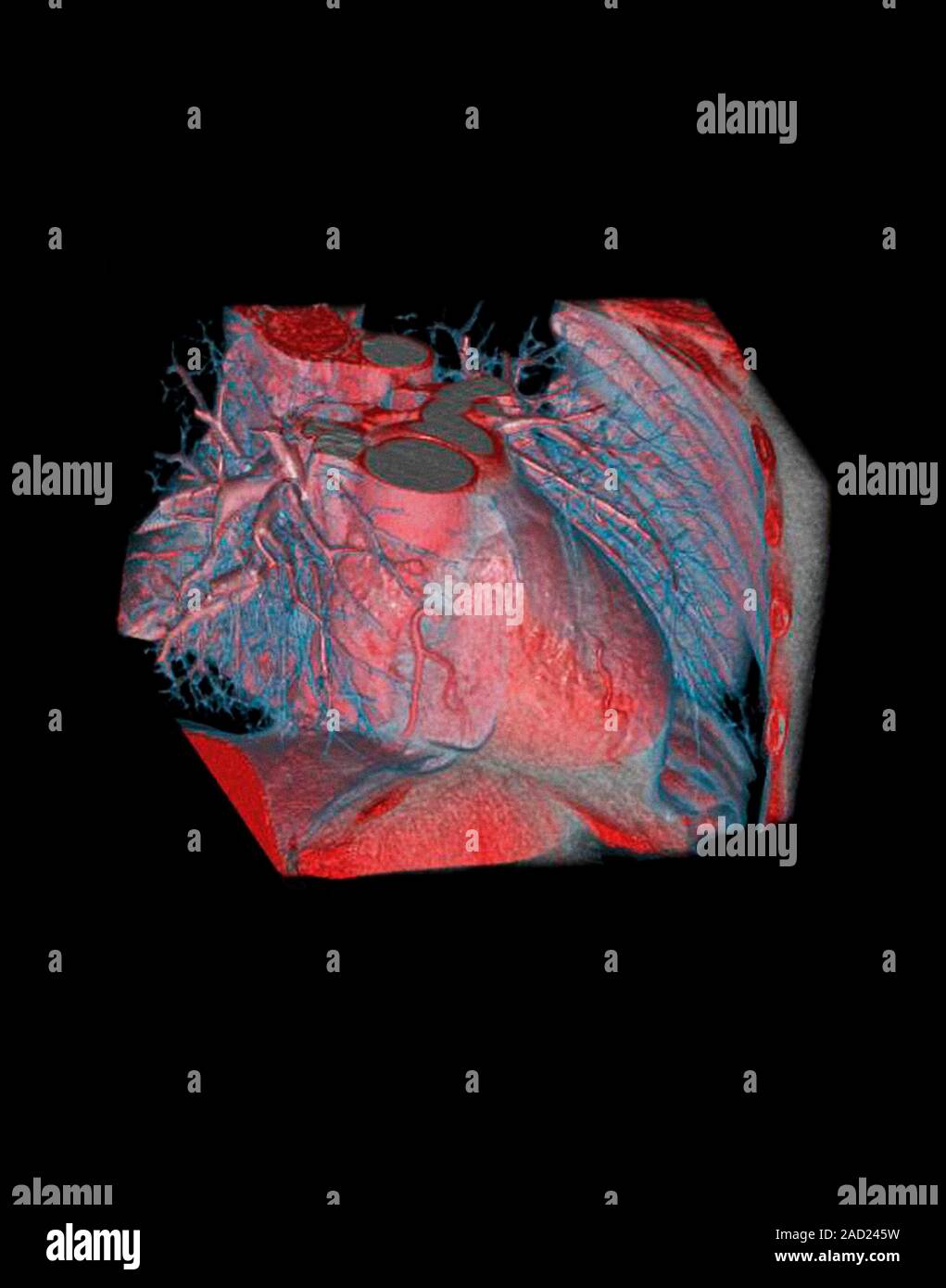 Human heart, computed tomography (CT) scan. The scan shows some of the ...