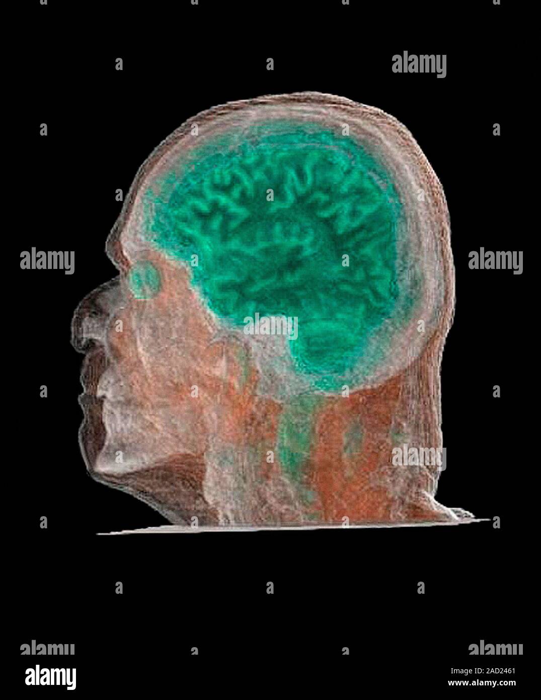 Human head and brain, computed tomography (CT) scan. The brain, the ...