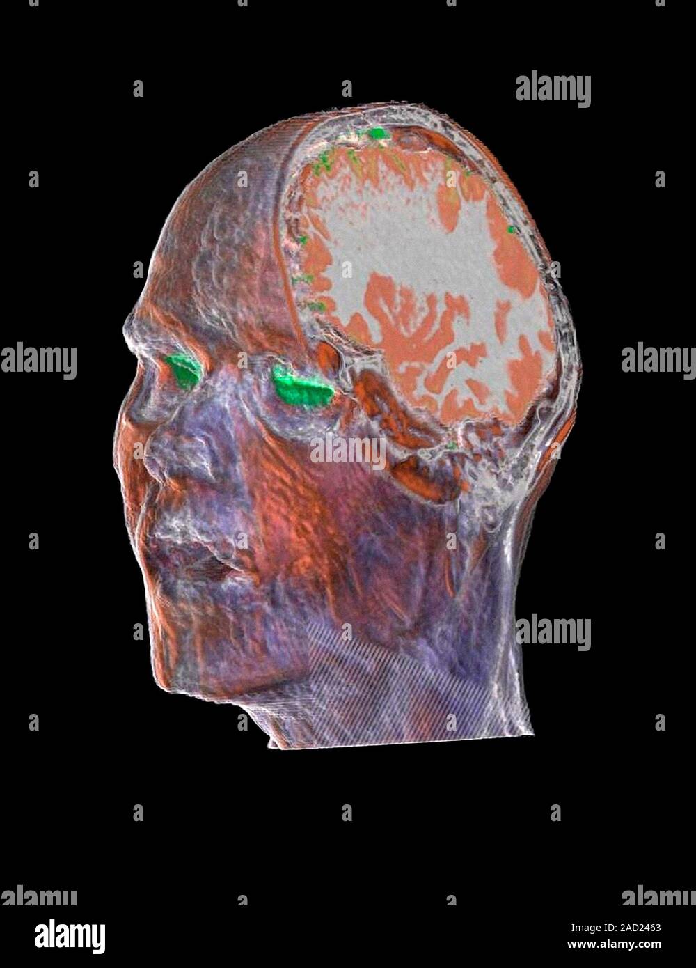Human head and brain, computed tomography (CT) scan. The diagonal ...
