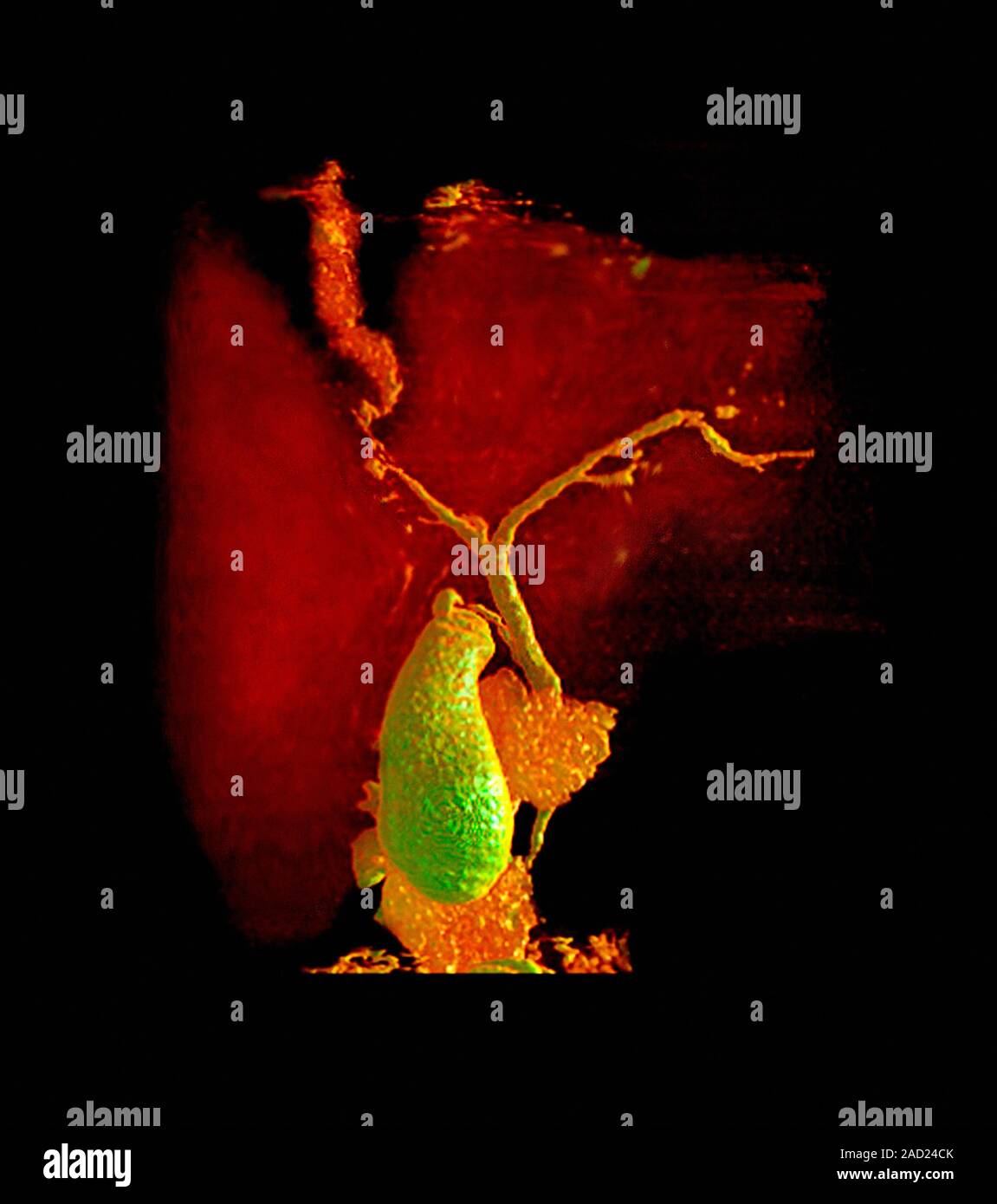 Liver disorder. Computed tomography (CT) scan of a hepatobiliary ...