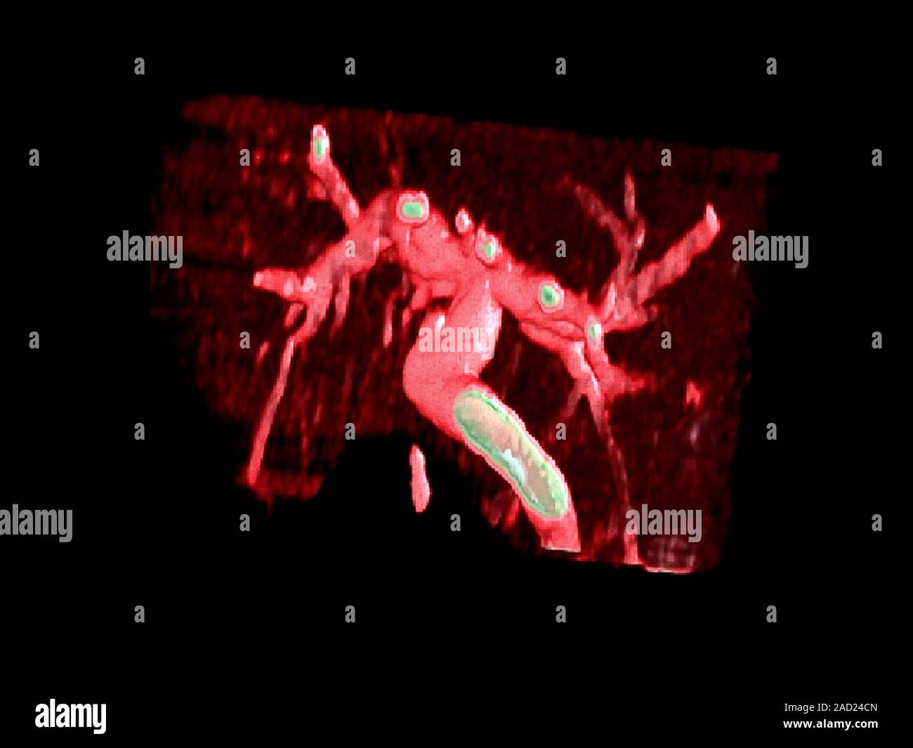 Blood vessels, computed tomography (CT) scan. CT scanning can be used ...