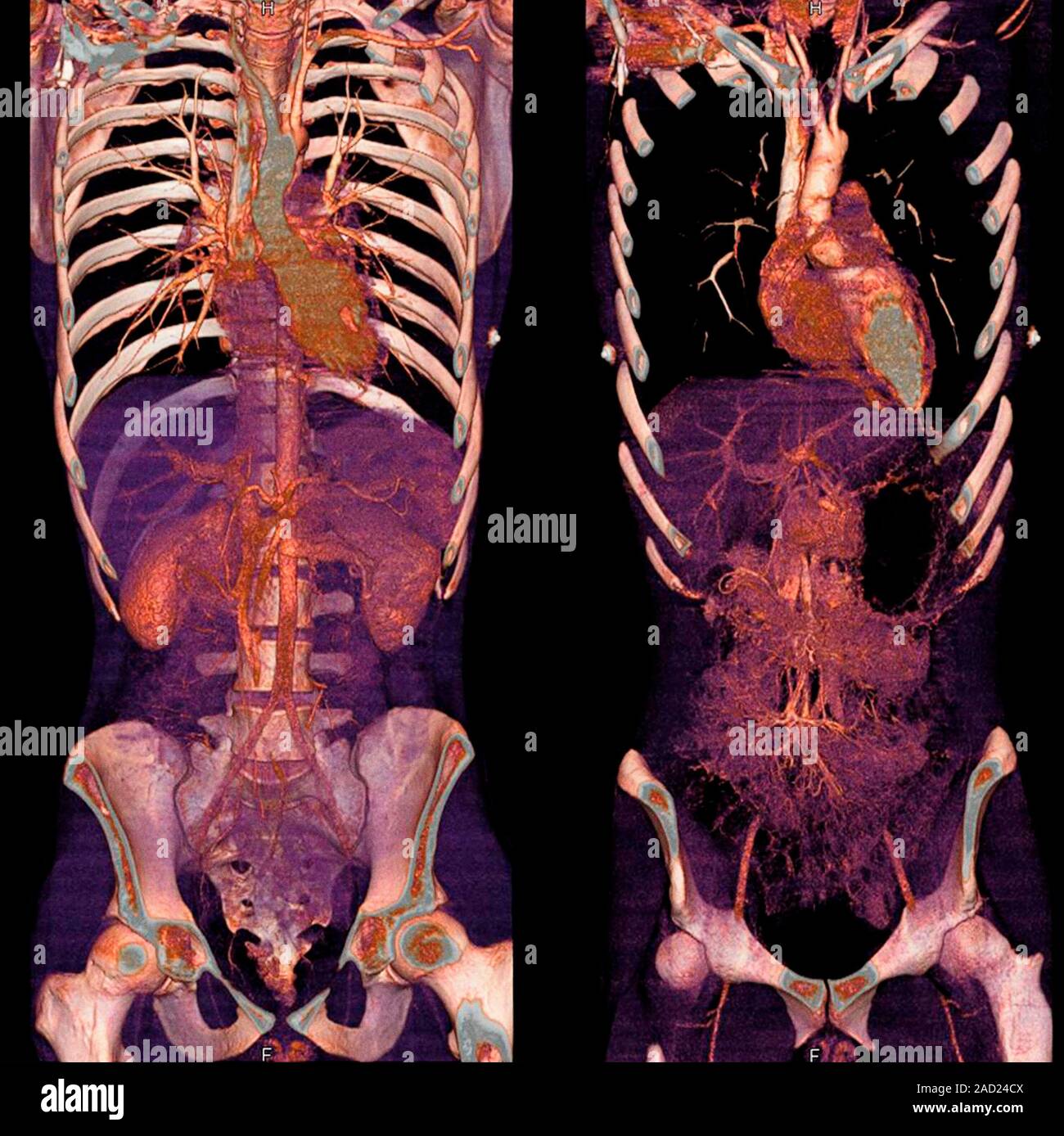 Chest and abdomen. Computed tomography (CT) scans of the bones and ...