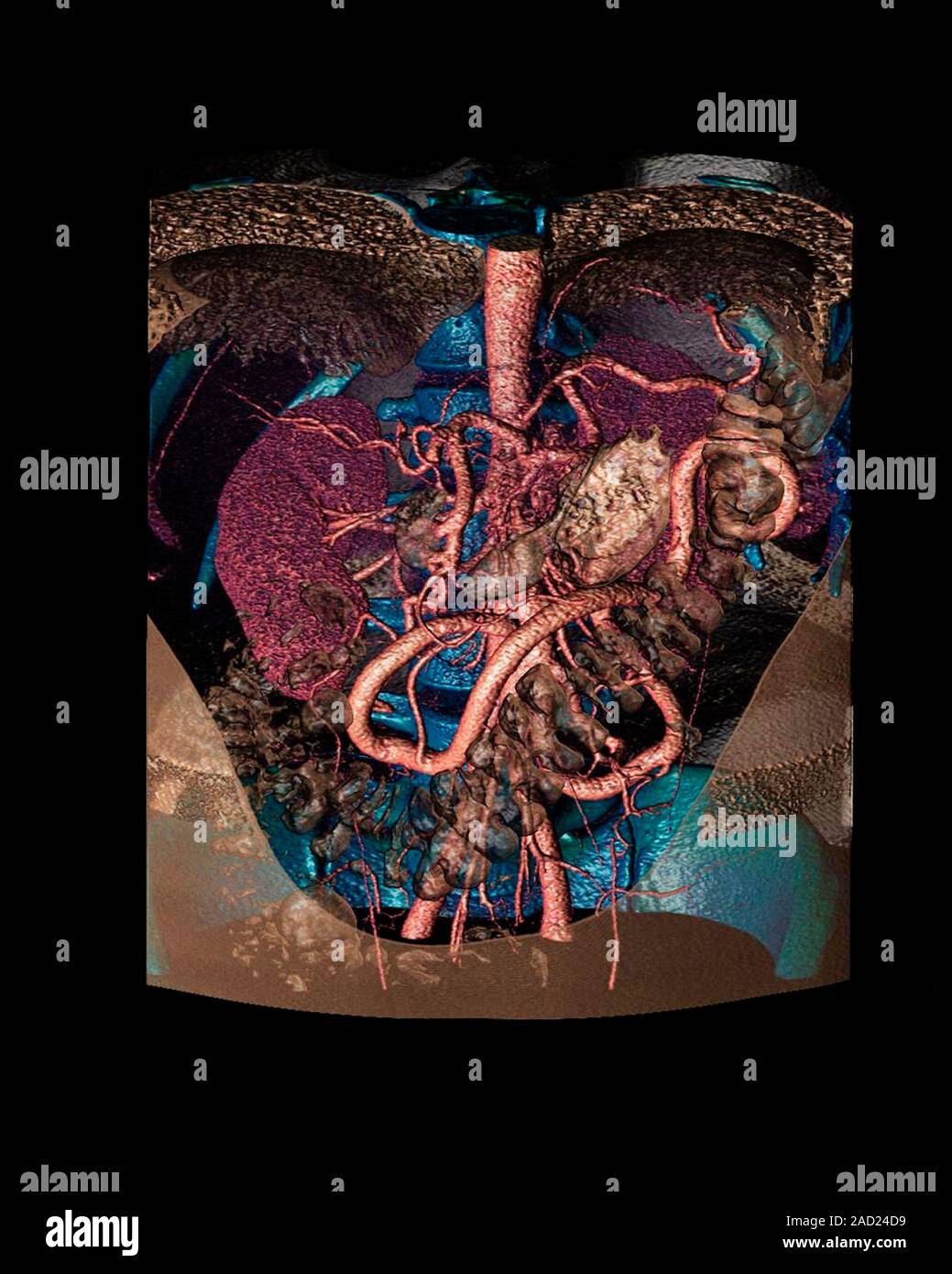 Distended mesenteric artery. Computed tomography (CT) scan of a human ...