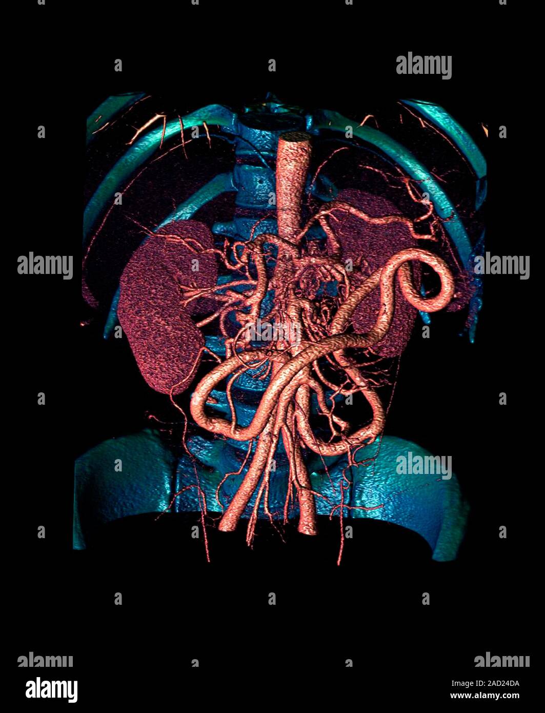 Distended mesenteric artery. Computed tomography (CT) scan of a human ...