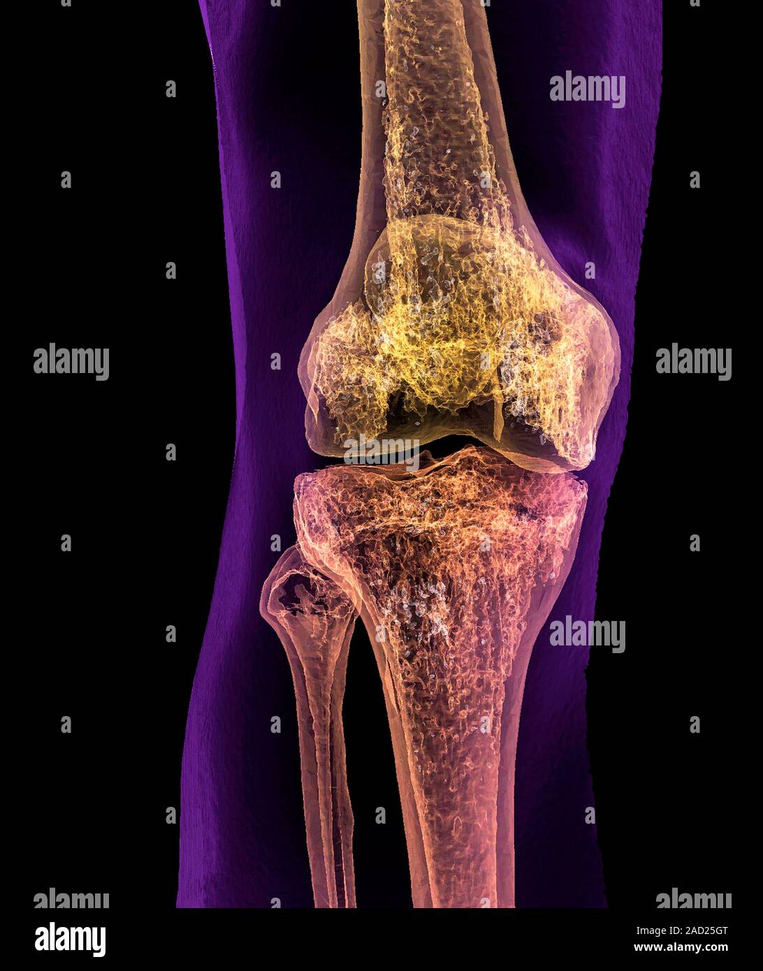 Normal adult knee. Coloured 3D reconstructed computed tomography (CT ...