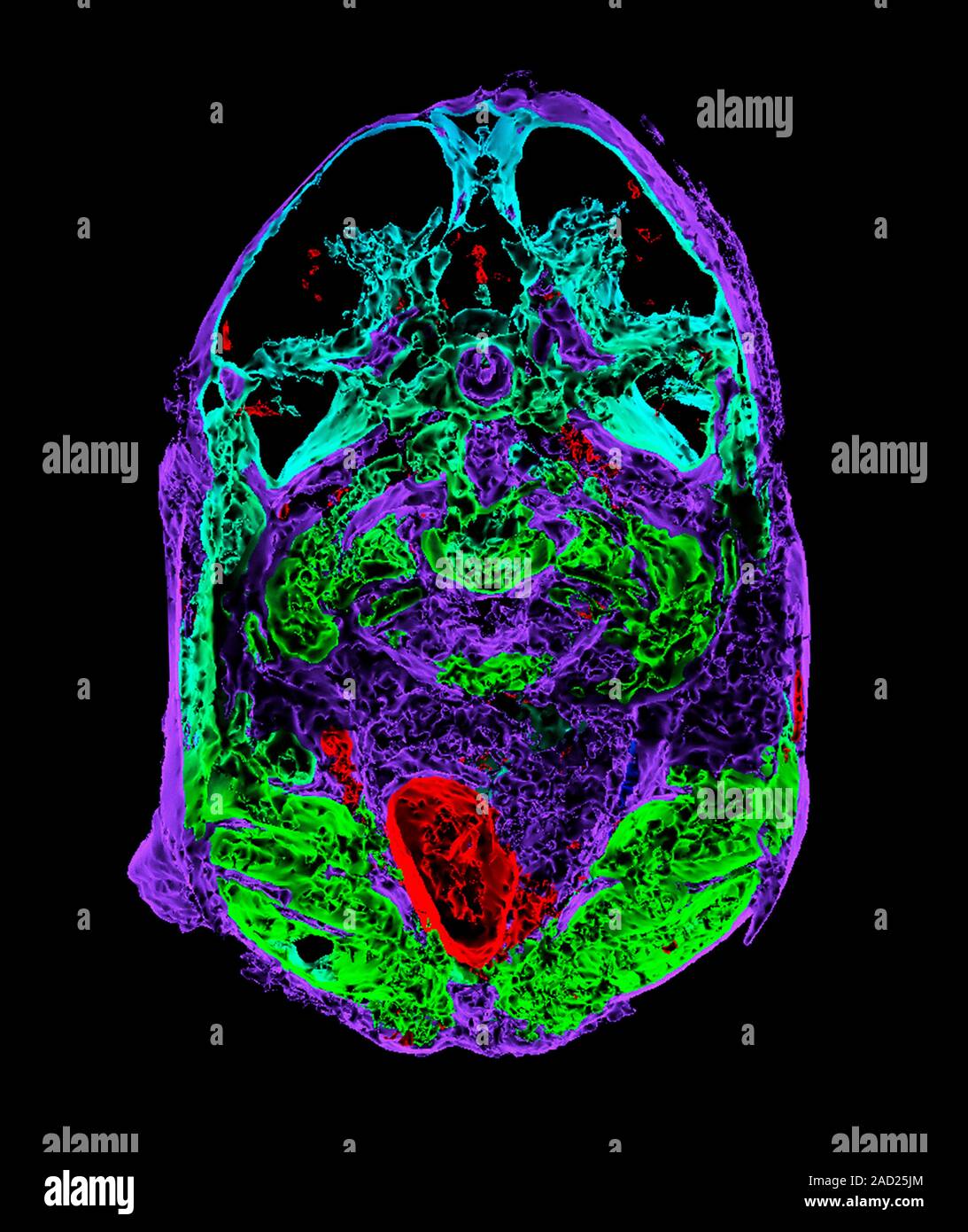 Zebrafish heart. Coloured 3D reconstructed micro-computed tomography ...