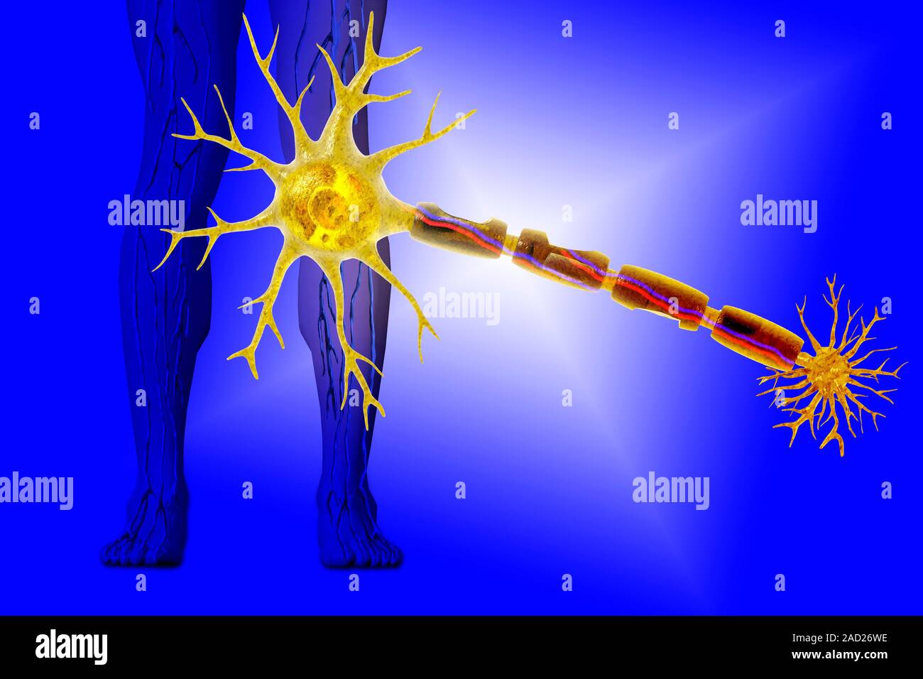Illustration of a damaged neuron. Diabetes can cause damage to the legs ...