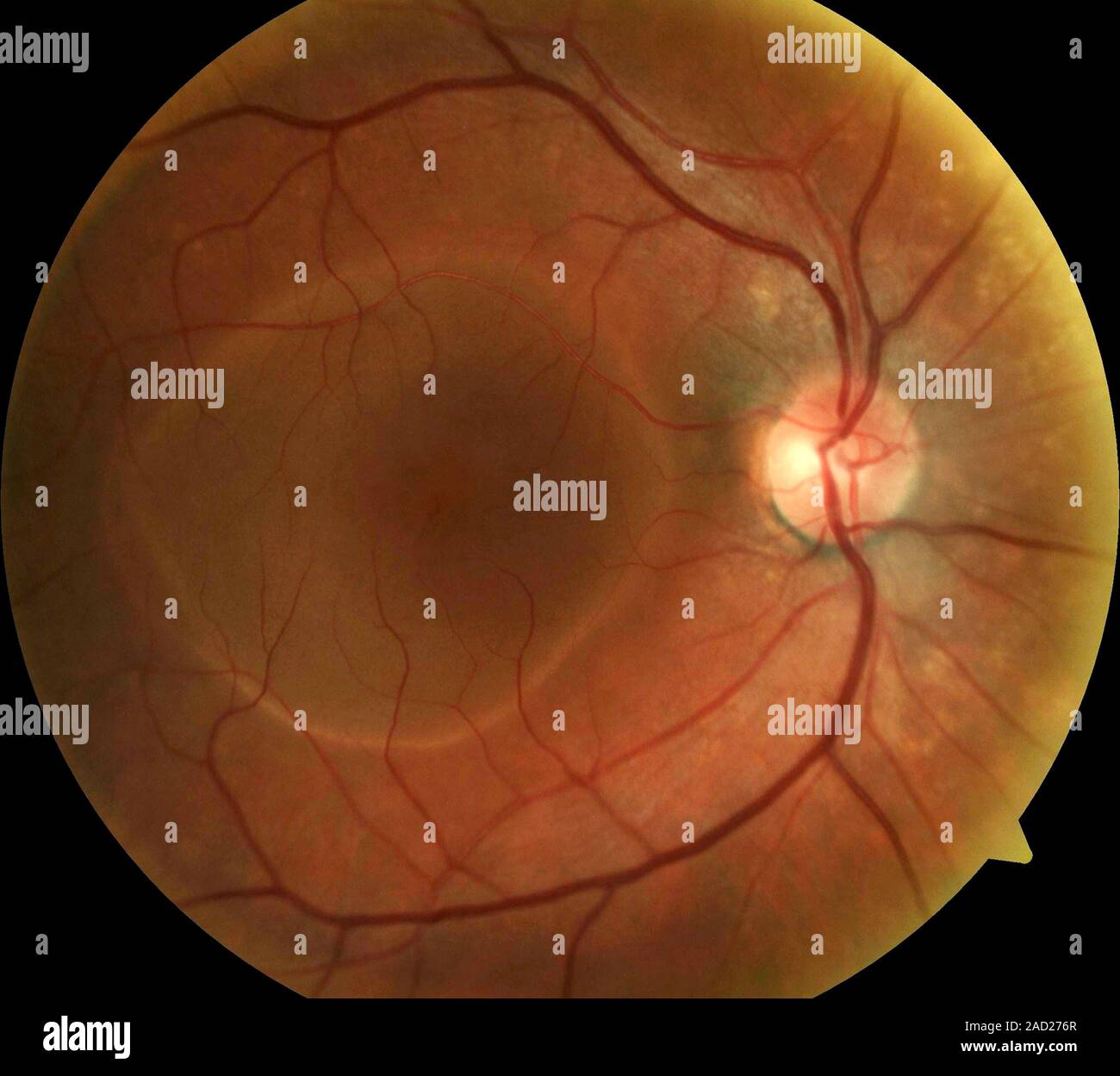 Retinal pigment epithelial detachment. Ophthalmoscope view of the ...