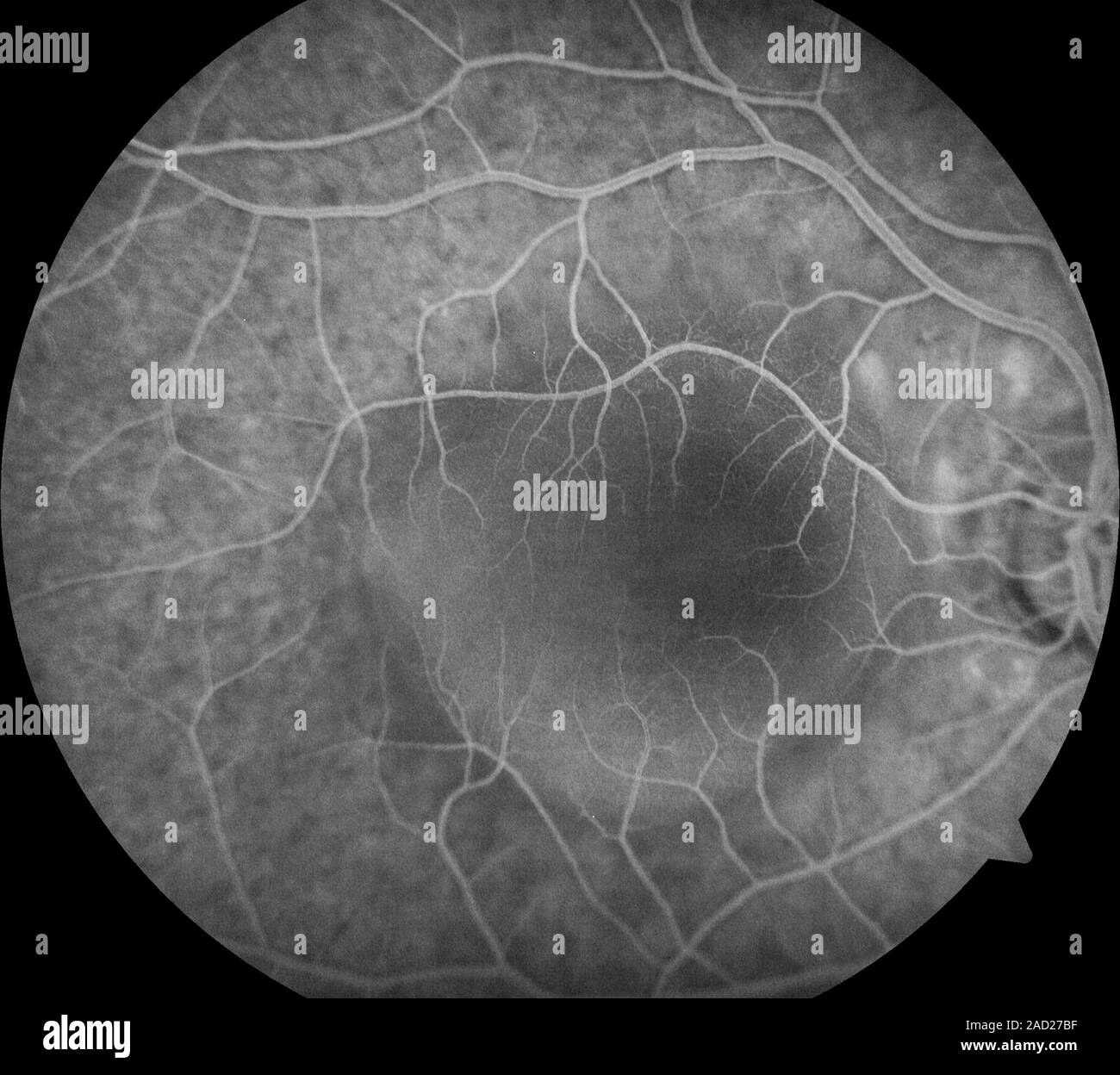 Retinal pigment epithelial detachment. Fundus fluorescein angiography ...
