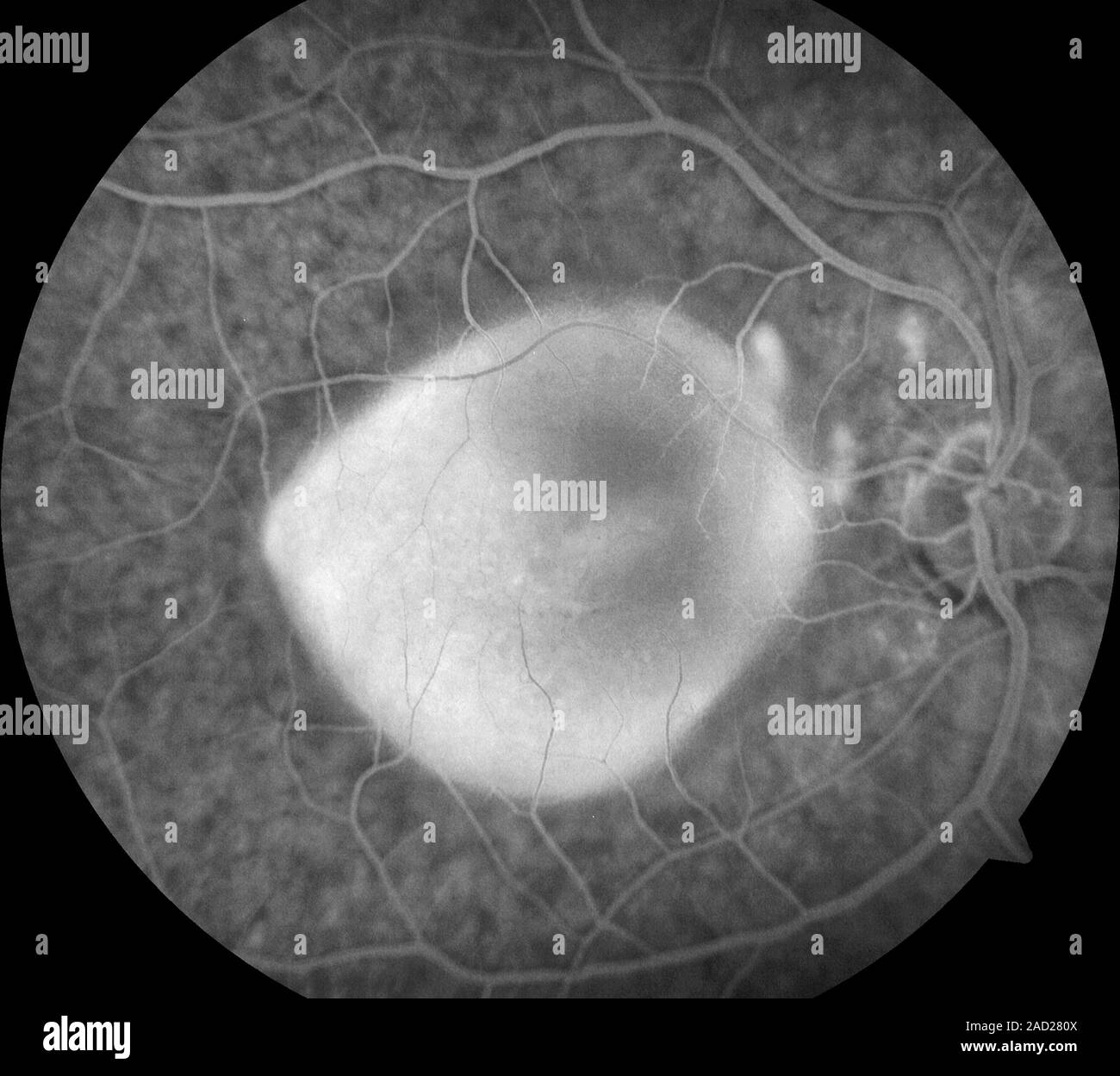 Retinal pigment epithelial detachment. Fundus fluorescein angiography ...