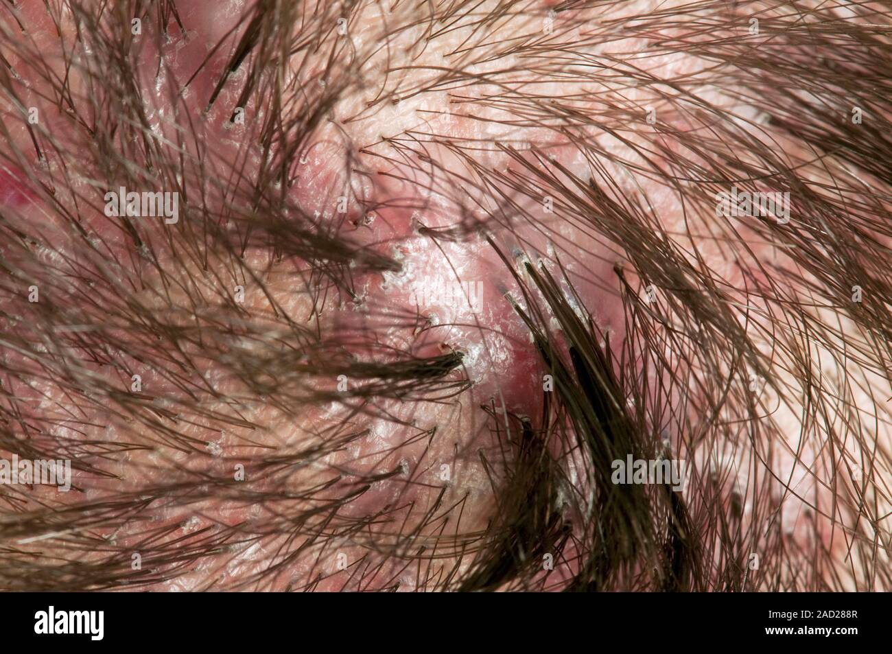 Folliculitis of the scalp of a 35-year-old man. Folliculitis is a bacterial infection of the ...
