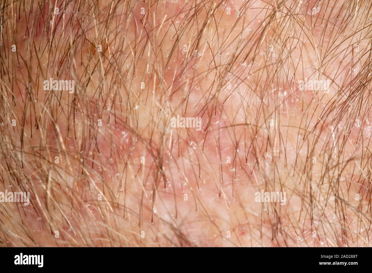 Folliculitis of the scalp of a 35-year-old man. Folliculitis is a ...
