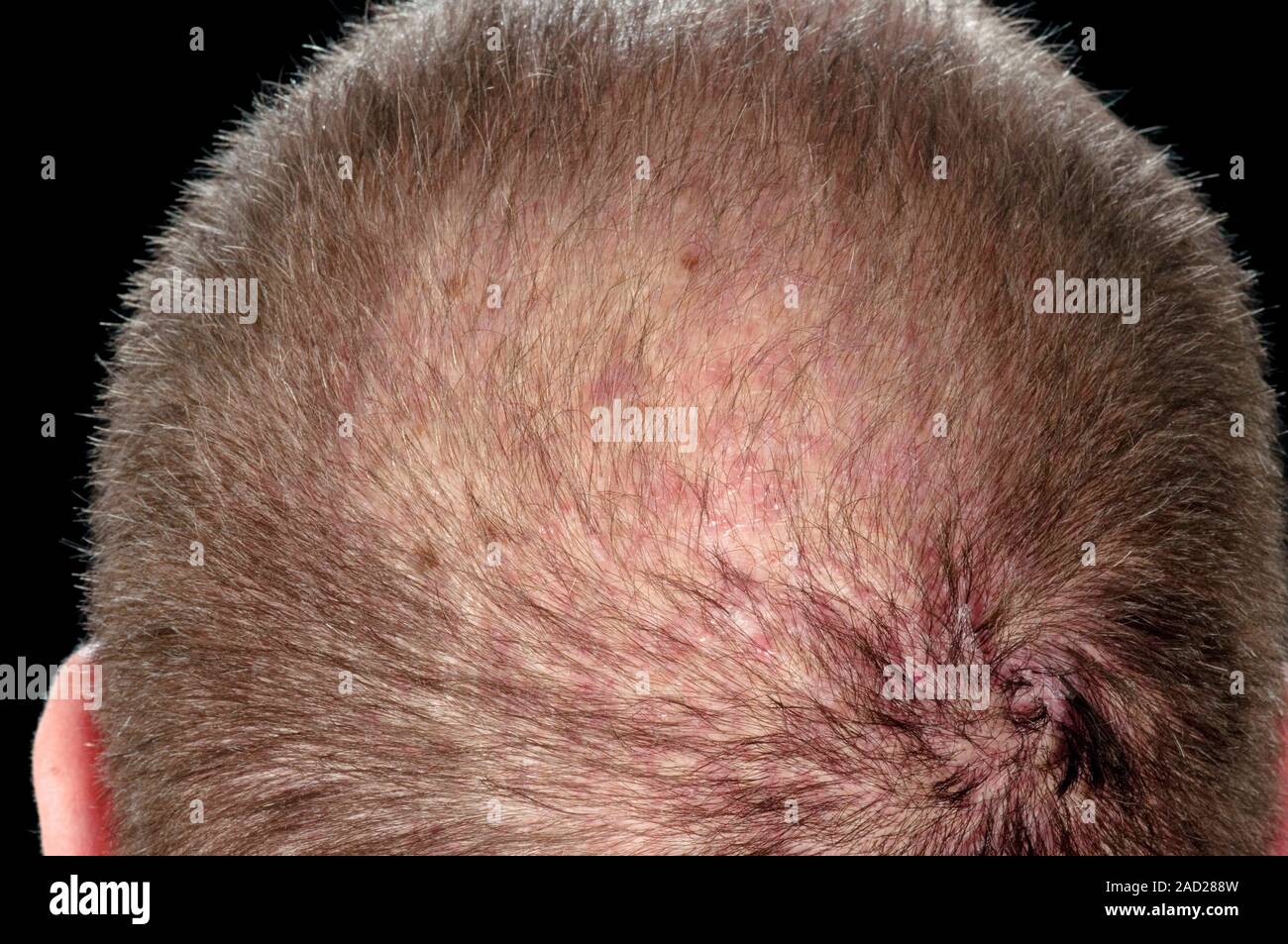 Folliculitis of the scalp of a 35-year-old man. Folliculitis is a ...