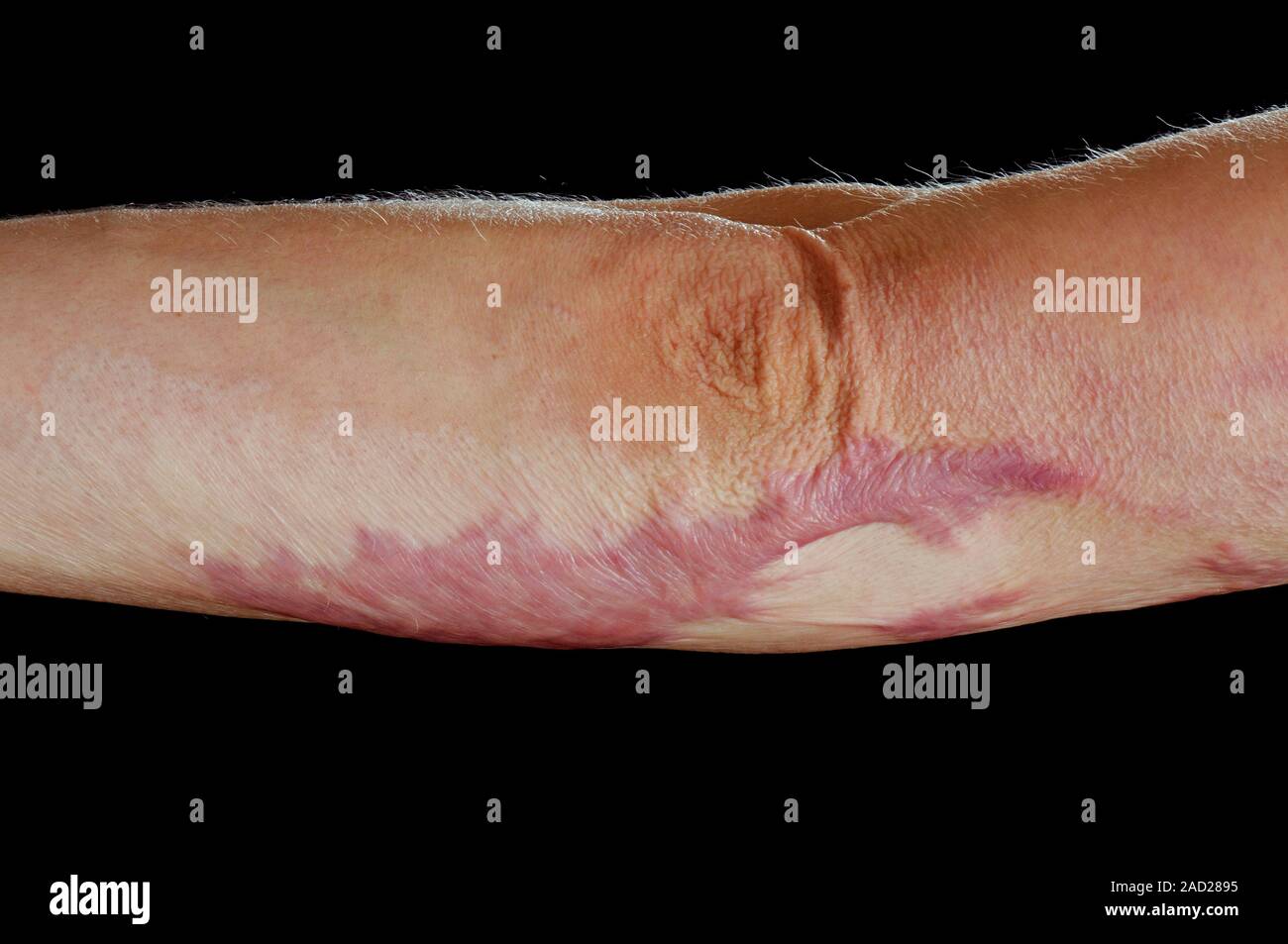 Burns scar. Scarring from a burn injury on the arm of a 35-year-old ...
