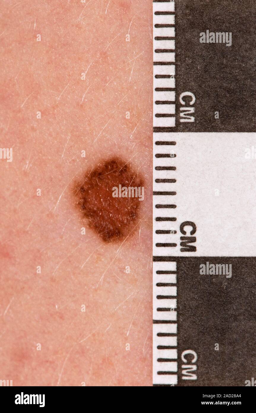 Mole diagnosis. Close-up of a mole on the upper arm of a 25-year-old ...