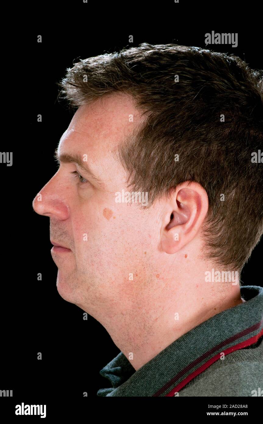 Solar lentigo. Side view of a 46-year-old man with a solar lentigo ...