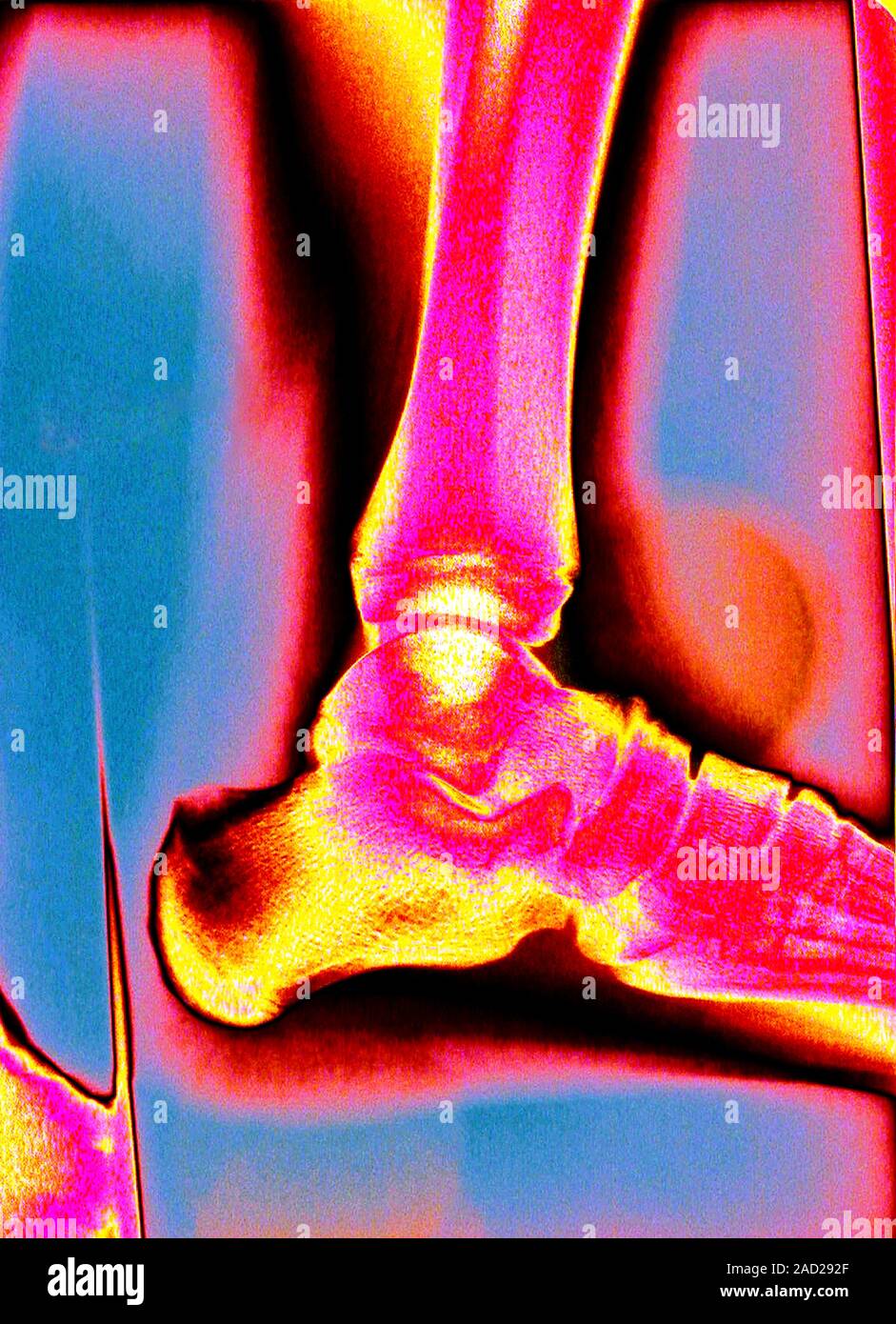 Ankle. Coloured X-ray of the bones of the lower leg, ankle and foot ...