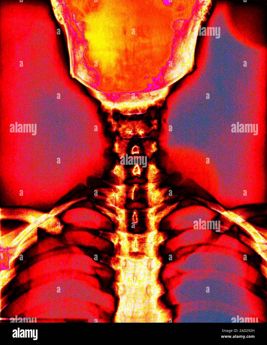 Neck vertebrae and skull. Coloured X-ray of the bones of the neck ...