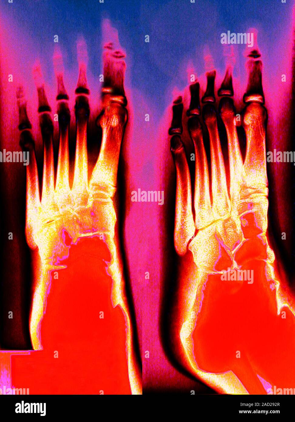 Feet. Coloured X-ray of the bones of the feet, with the big toe at ...