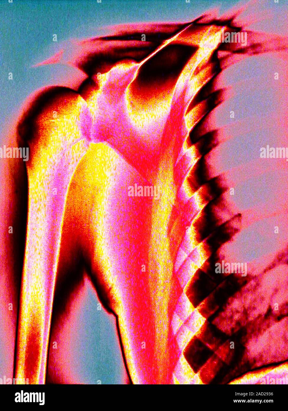 Shoulder. Coloured X-ray of the bones of a human shoulder, showing the ...