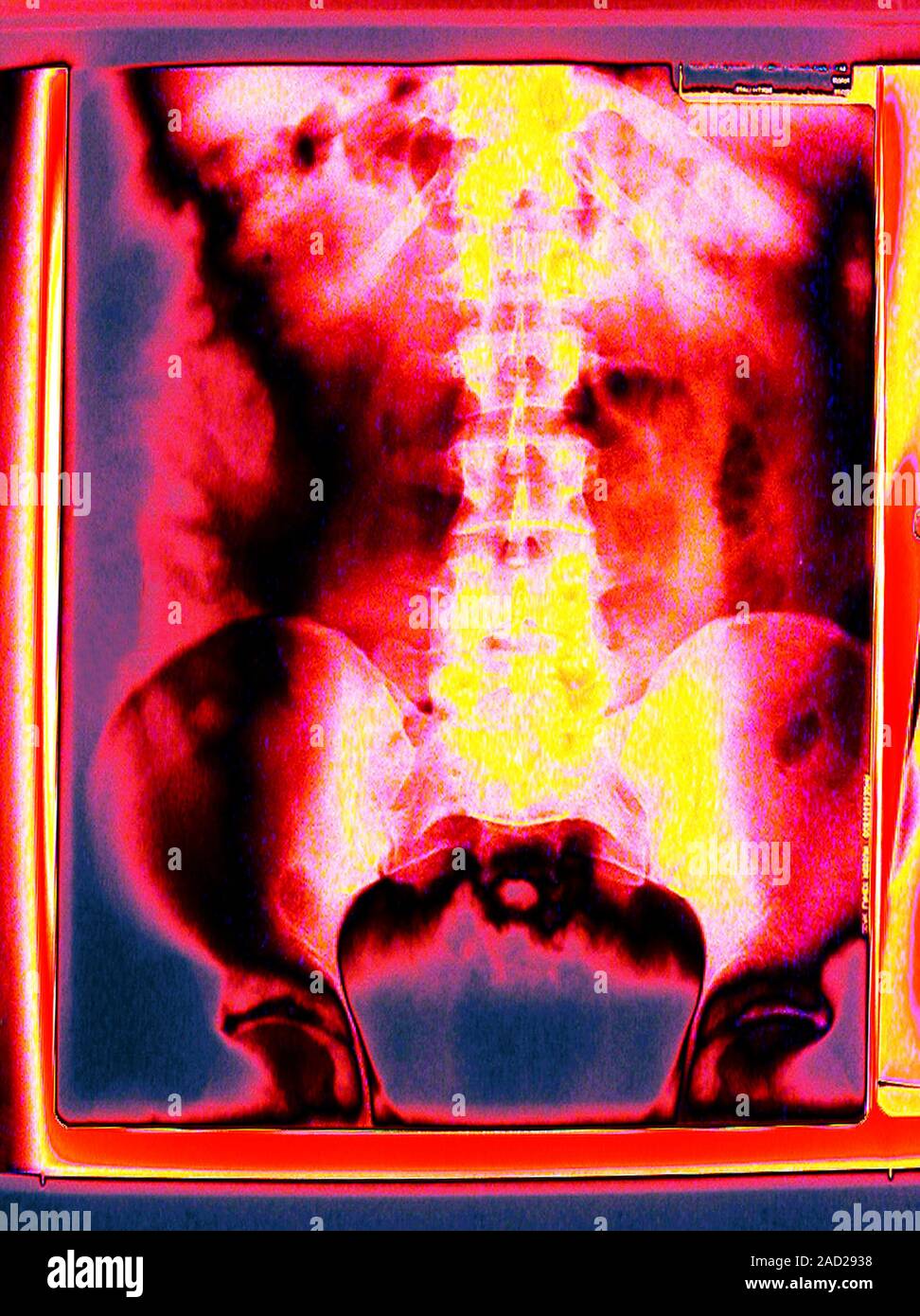 Backbone. Coloured X-ray of a frontal view of the lower part of a human ...