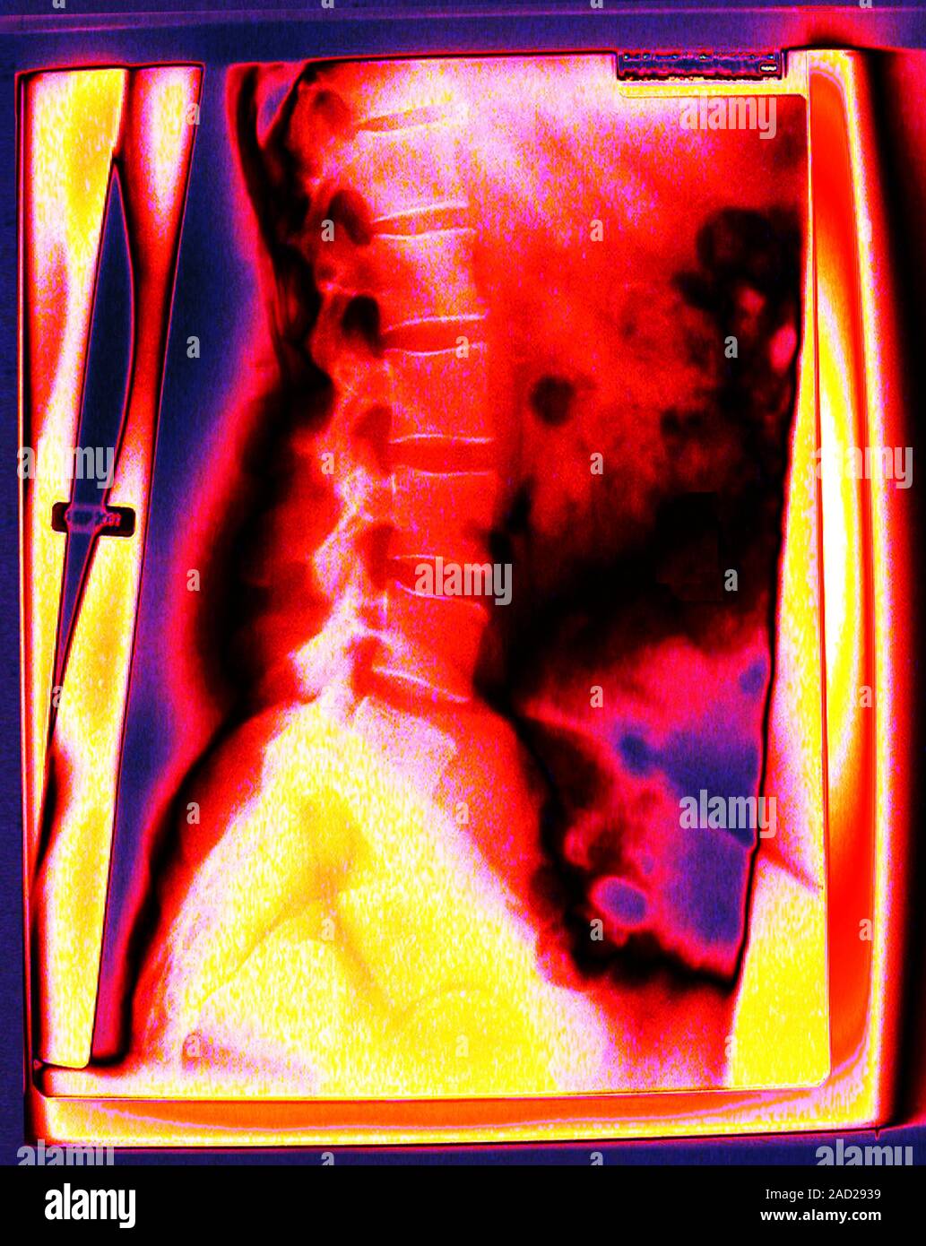 Backbone. Coloured X-ray of a side view of the lower part of a human ...