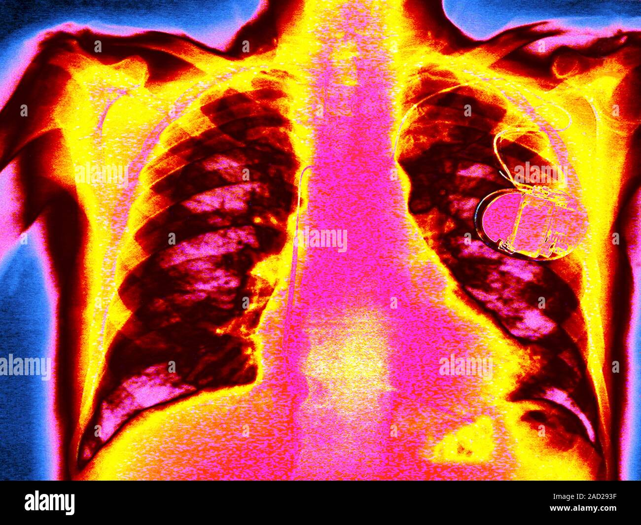 Defibrillator. Coloured chest X-ray of the chest of a patient who has ...