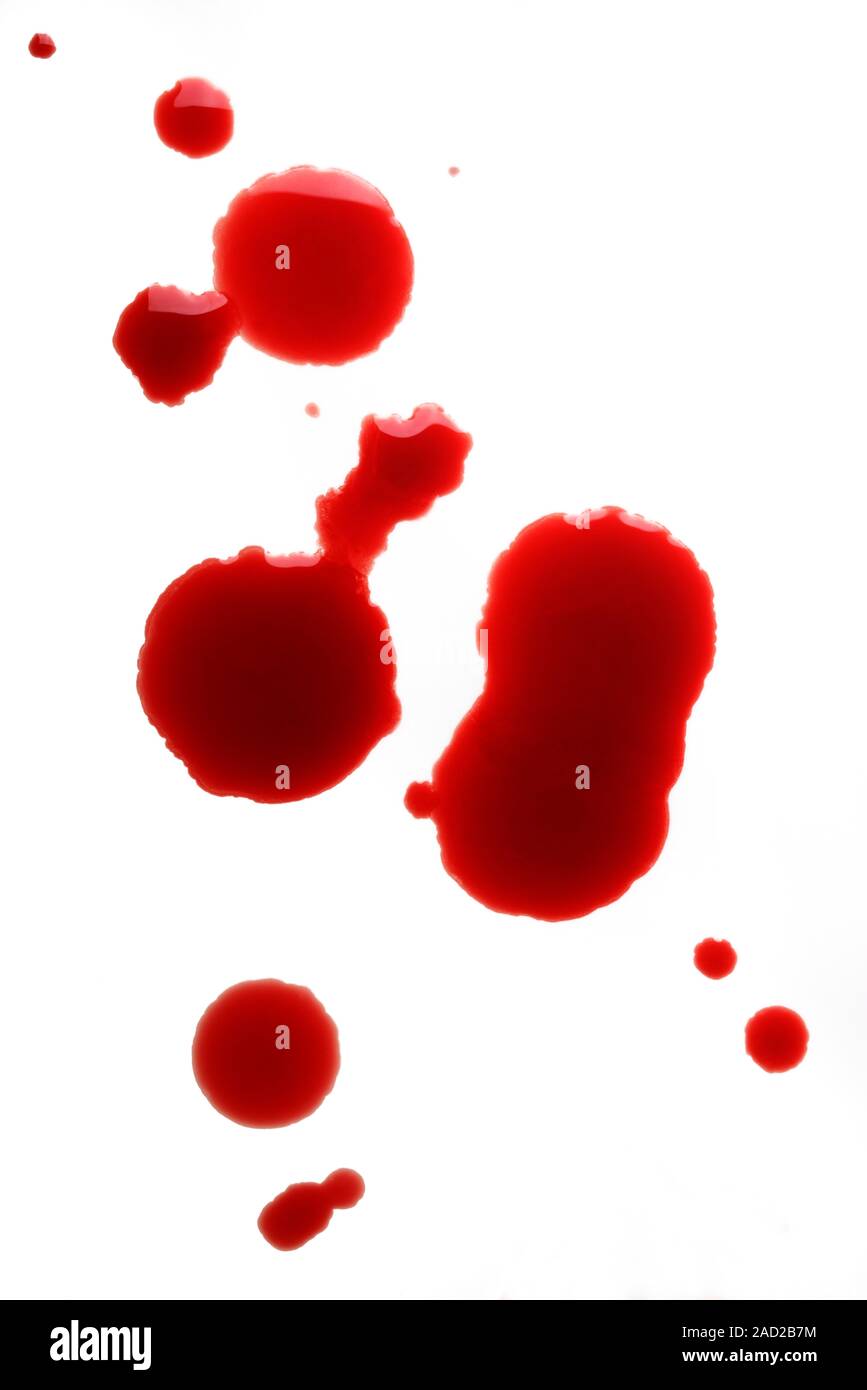 Blood spatter. In forensic science, the pattern created by projected ...