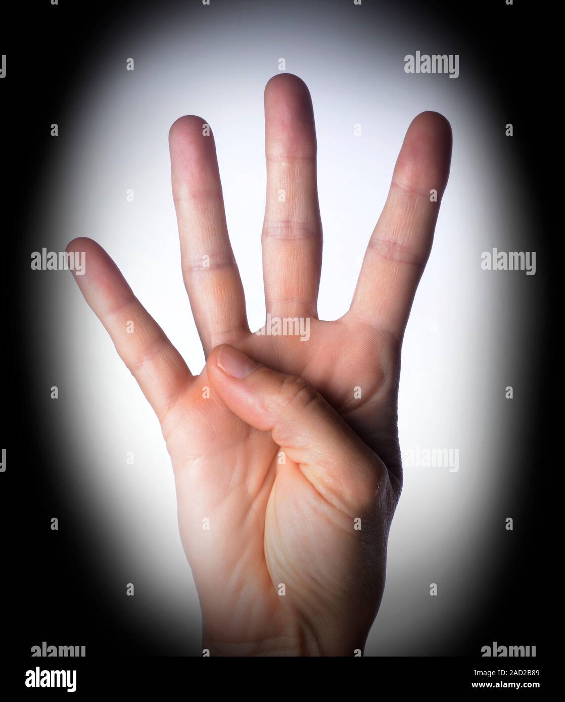 Glaucoma. Simulated view of a hand with four fingers held up as seen by ...