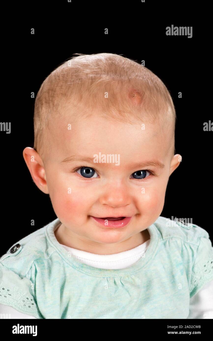 Juvenile xanthogranuloma. 15-month-old girl with juvenile ...