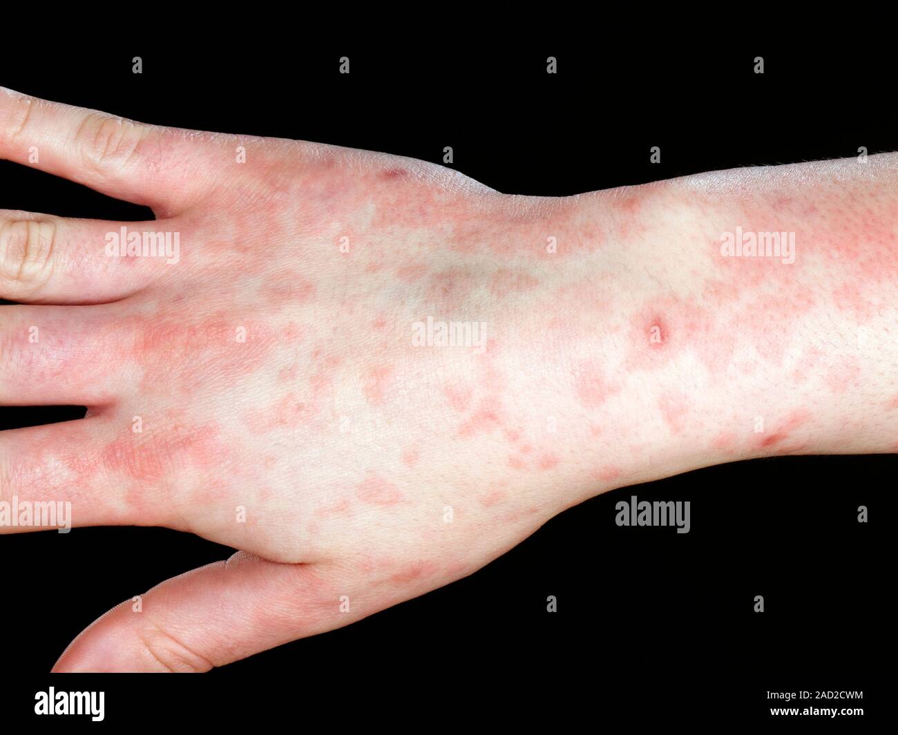 Epstein-Barr virus infection. Close-up of the hand of a 19-year-old ...