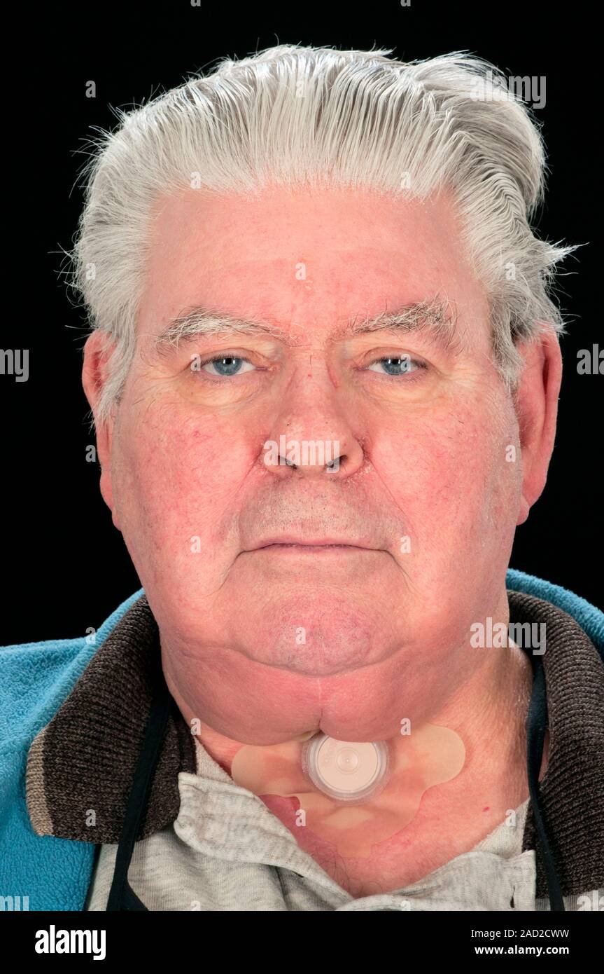 Laryngectomy stoma. 62-year-old male patient with a stoma (opening) in ...
