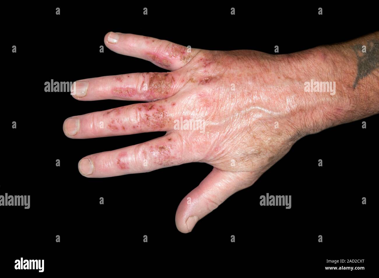 Chemical burns. Close-up of chemical burns on the hand of a 68-year-old ...