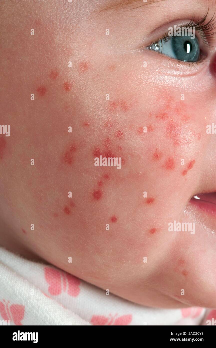 Chicken pox. Close-up of a chicken pox rash on the face of a 6-month ...