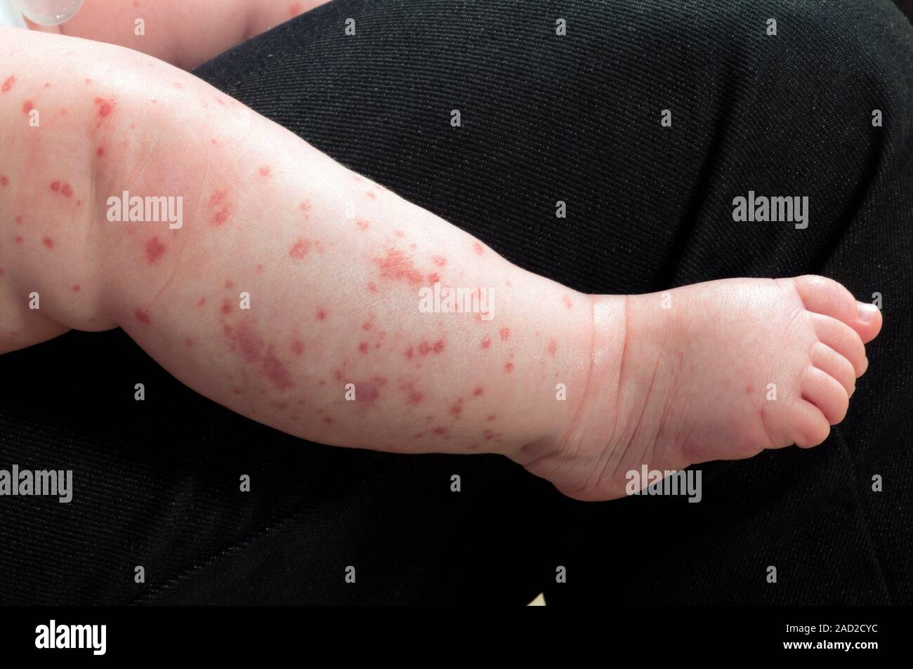 Chicken pox. Close-up of a chicken pox rash on the leg of a 6-month-old ...