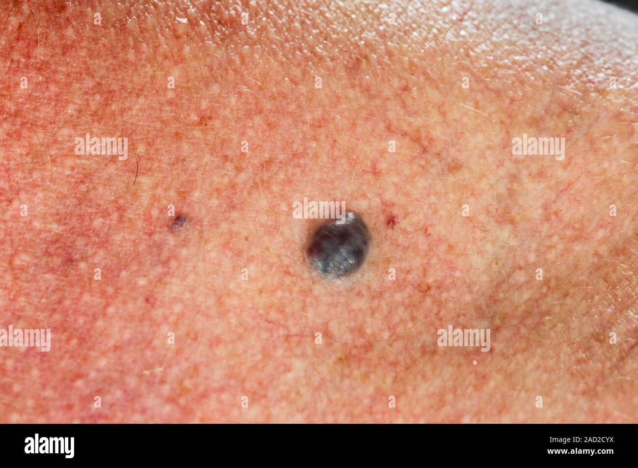 Blue rubber bleb nevus syndrome. Close-up of a mole-like lesion (nevus ...