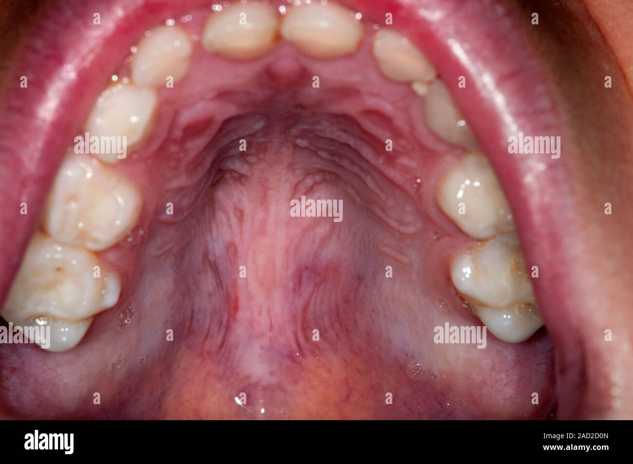 Hyper IgE syndrome. Mouth of a 7-year-old male patient with ...