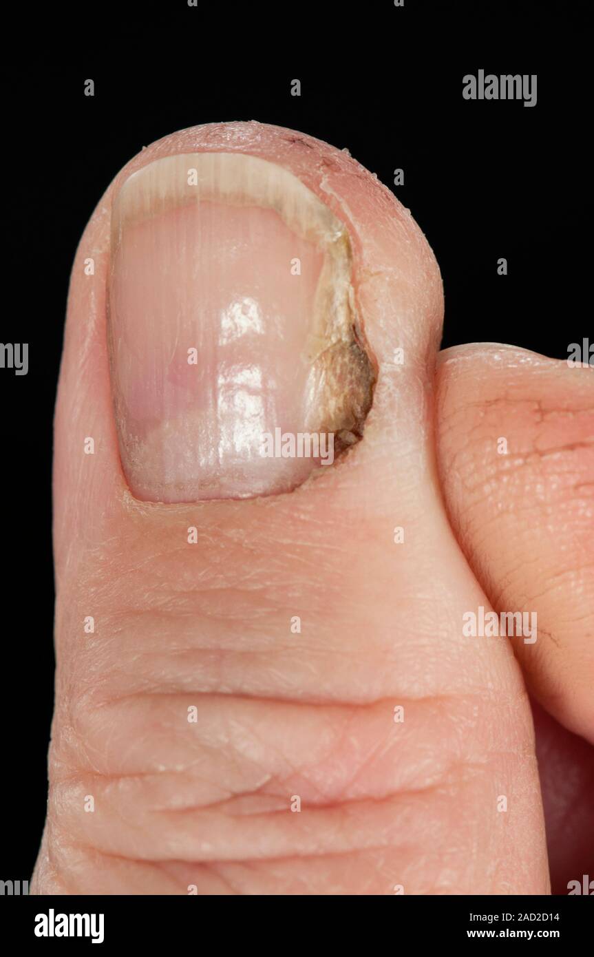 Discoloured nail. Close-up of the nail of a 68-year-old male patient ...