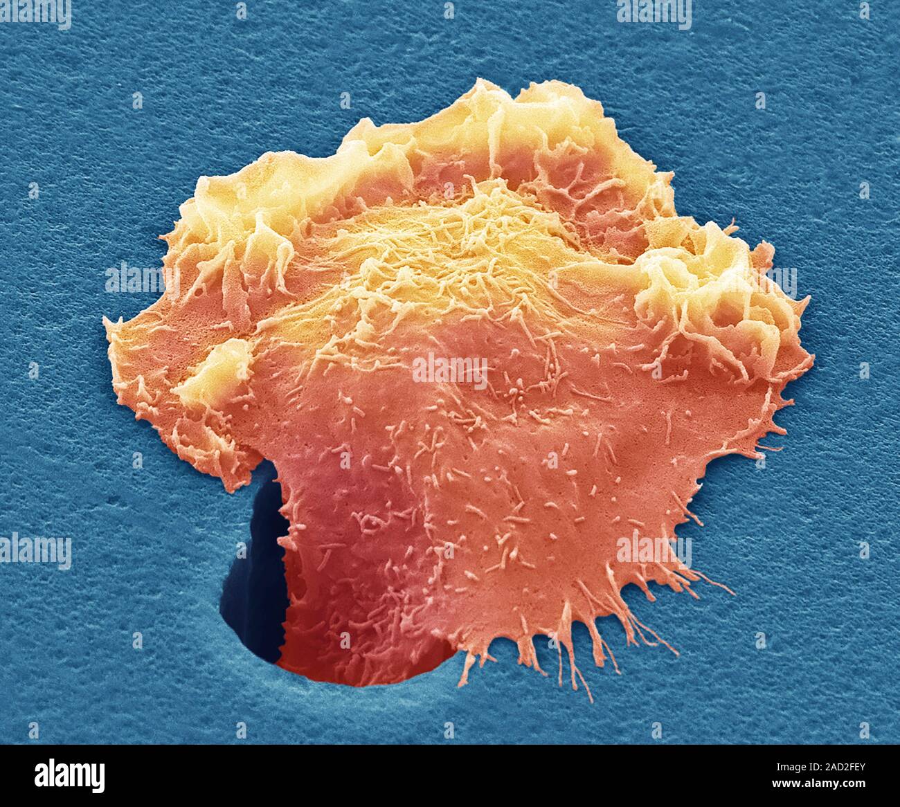 Migrating cancer cell. Coloured scanning electron micrograph (SEM) of a ...
