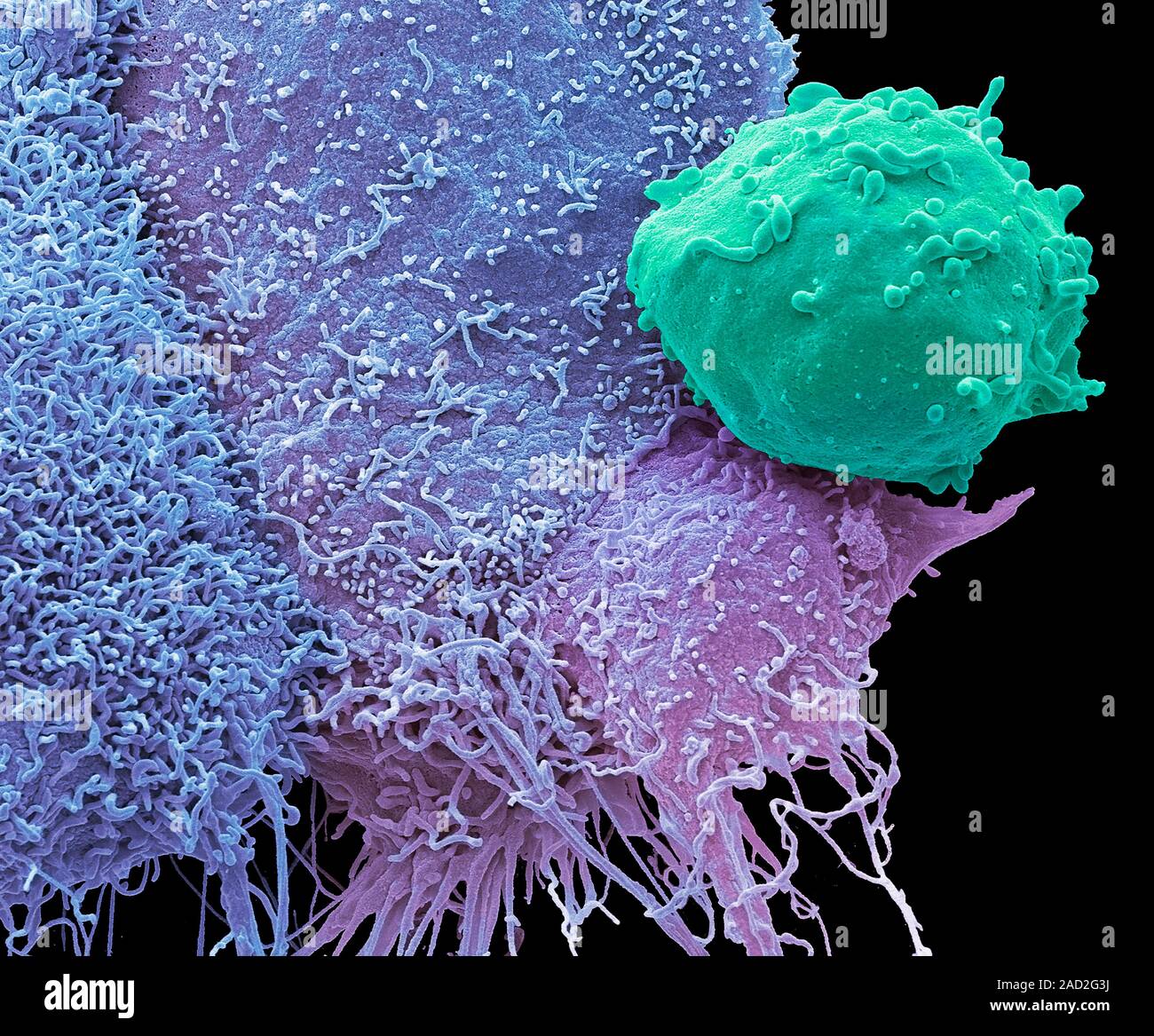 Cancer cells and monocyte. Coloured scanning electron micrograph (SEM ...