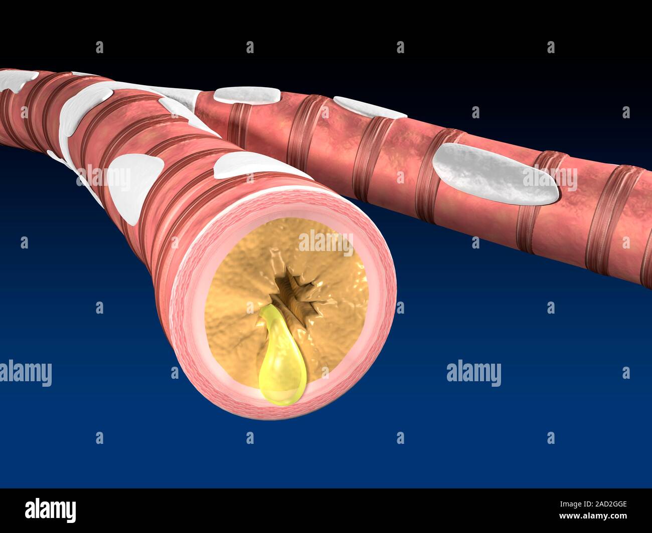 Acute bronchitis. Computer illustration of a section through a bronchus ...