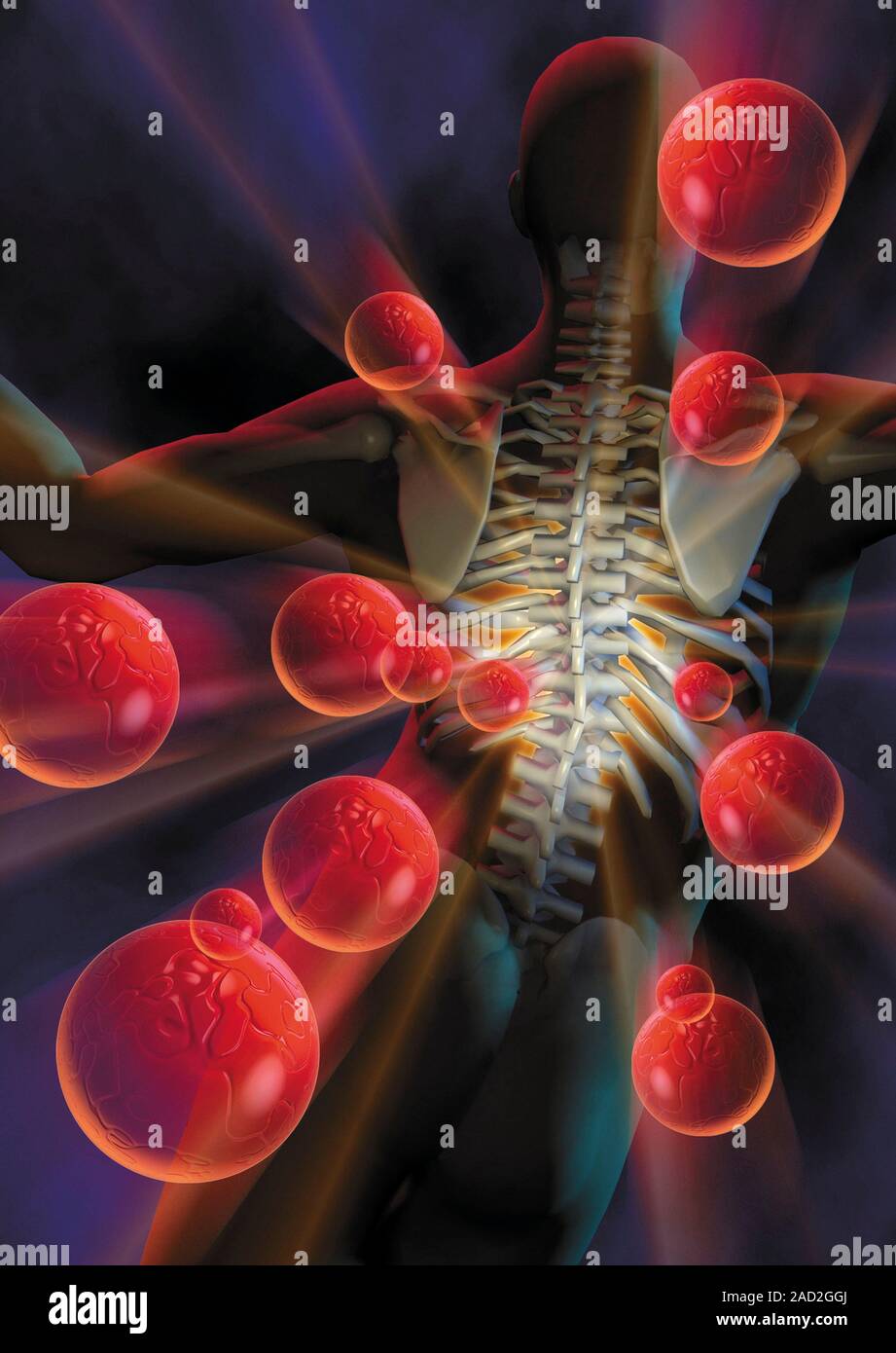 Back pain caused by infection, conceptual computer illustration Stock ...