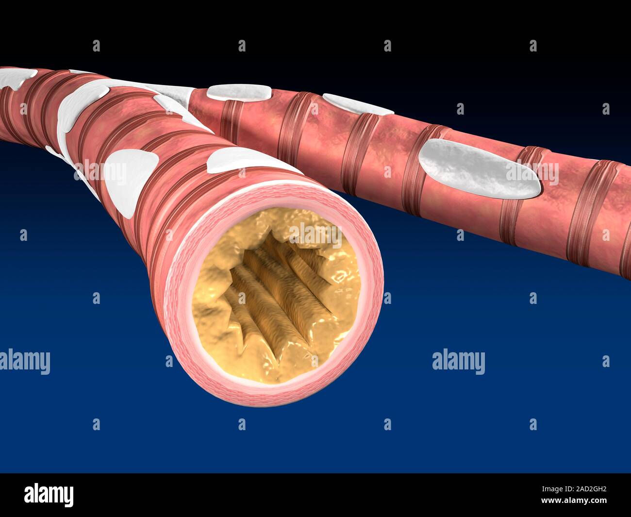 Blocked bronchus. Computer illustration of a section through a blocked ...