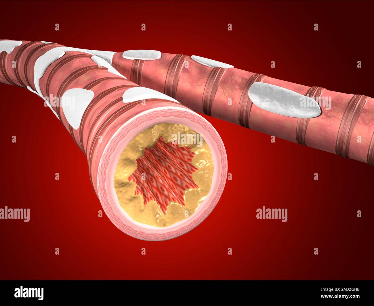 Blocked bronchus. Computer illustration of a section through a blocked ...
