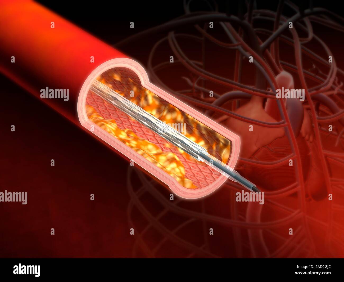 Angioplasty. Computer illustration showing a stent (wire mesh) being ...