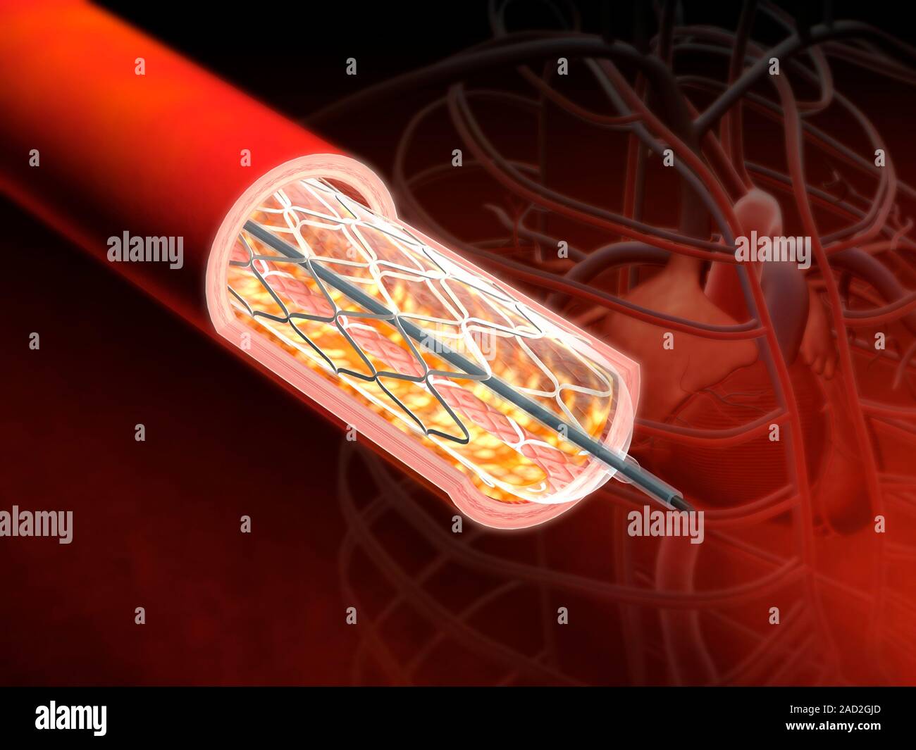 Angioplasty. Computer illustration showing a stent (wire mesh ...