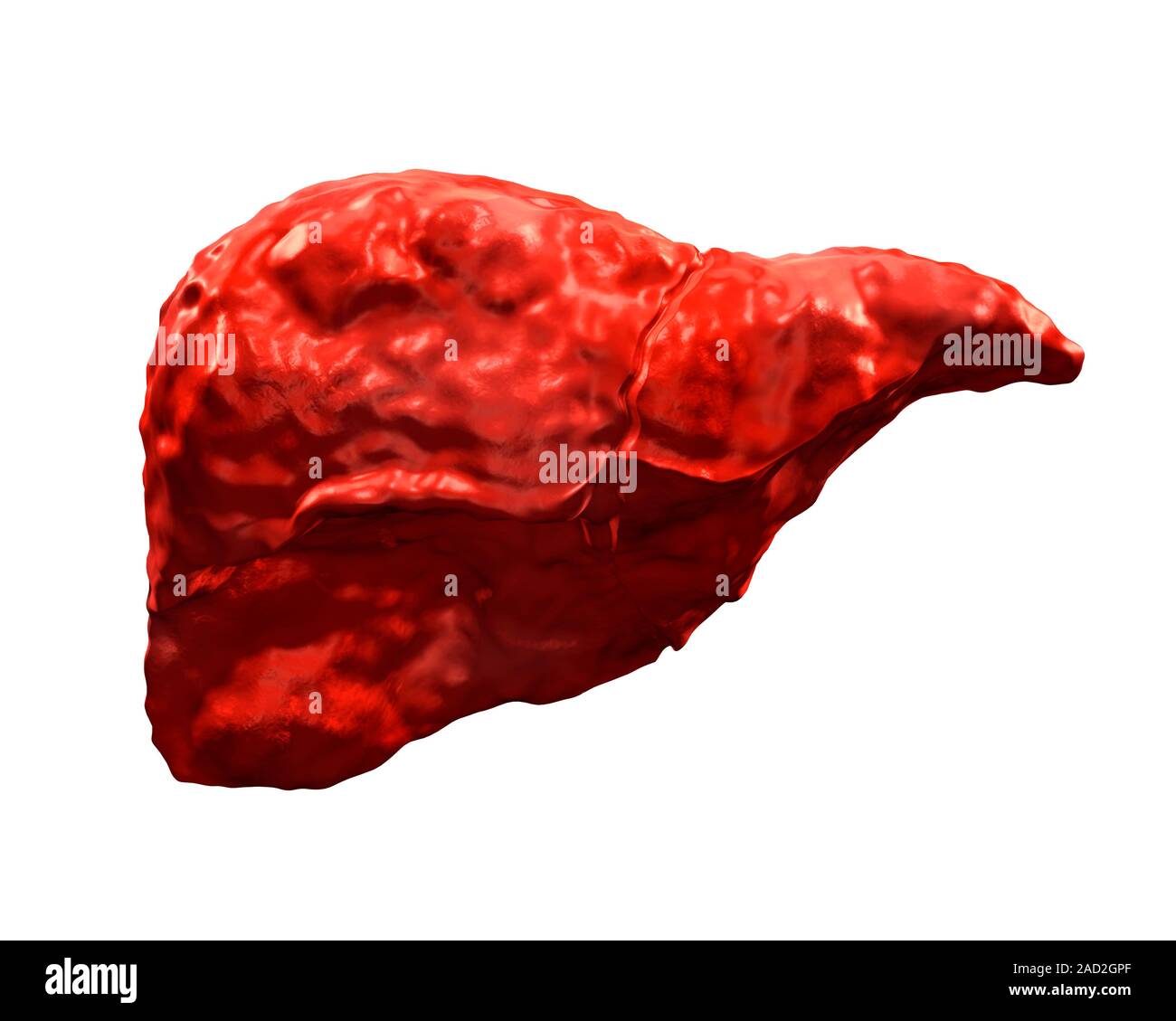 Cirrhotic liver. Computer illustration of a liver affected by cirrhosis ...