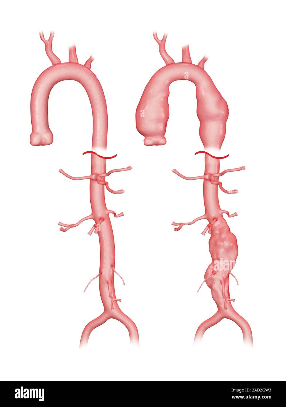 Aortic aneurysm. Computer illustration comparing a normal thoracic ...