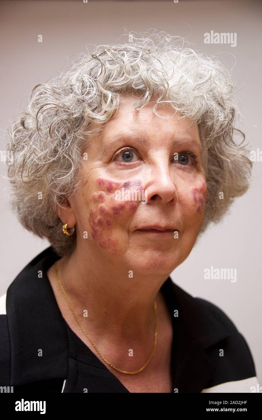 Laser treatment for age spots. 71-year-old woman with laser burn marks ...